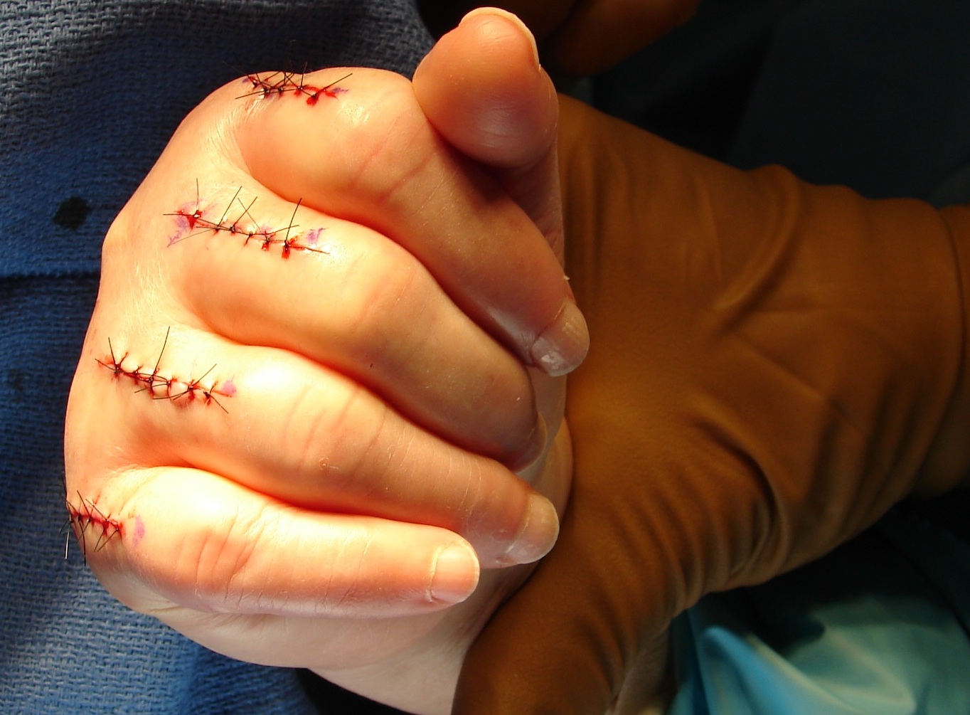 INTRINSIC TIGHTNESS (INTRINSIC CONTRACTURES) | Hand Surgery Resource